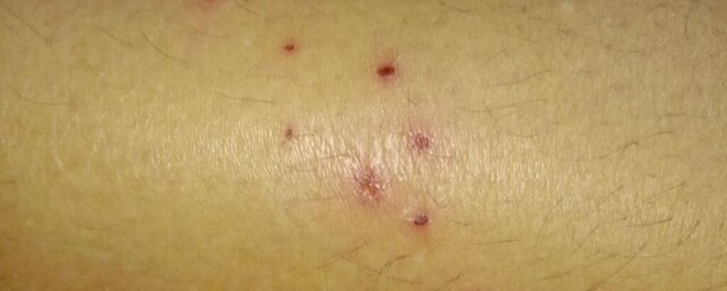 Understanding Folliculitis: Causes, Symptoms, and Prevention Tips