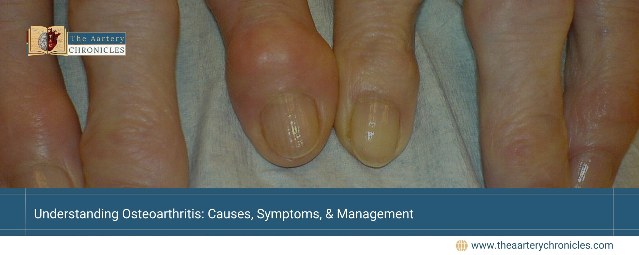 Osteoarthritis Demystified: Everything You Need to Know