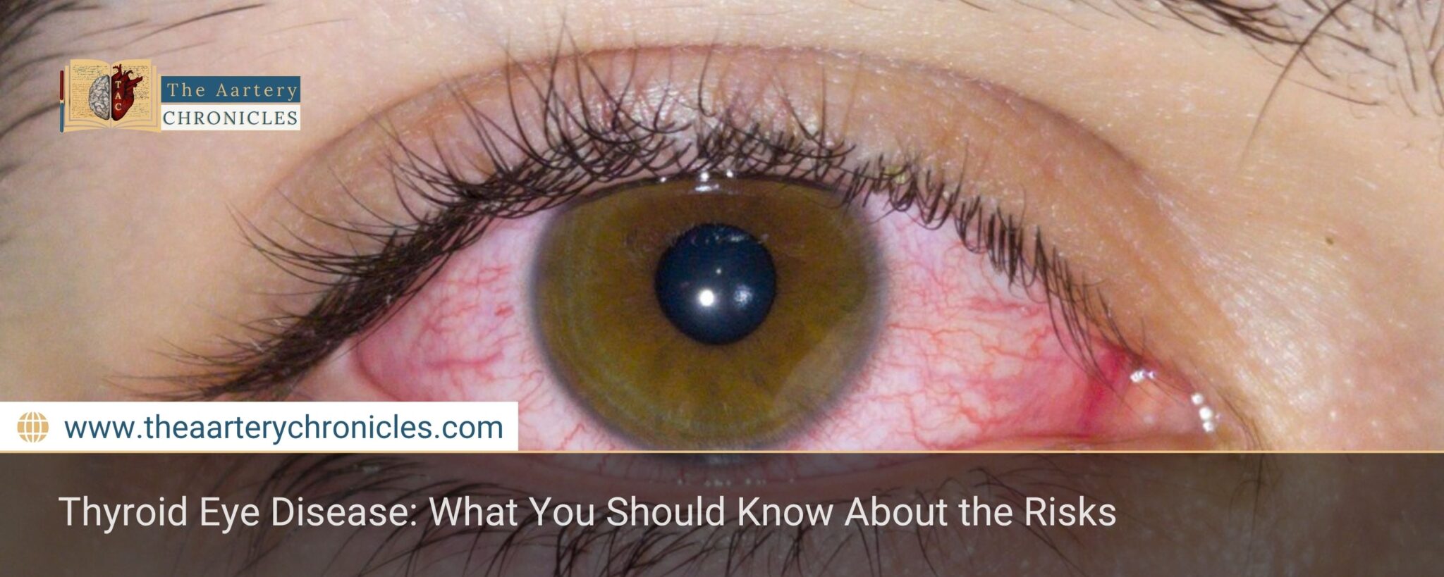 Thyroid Eye Disease: What You Should Know About the Risks