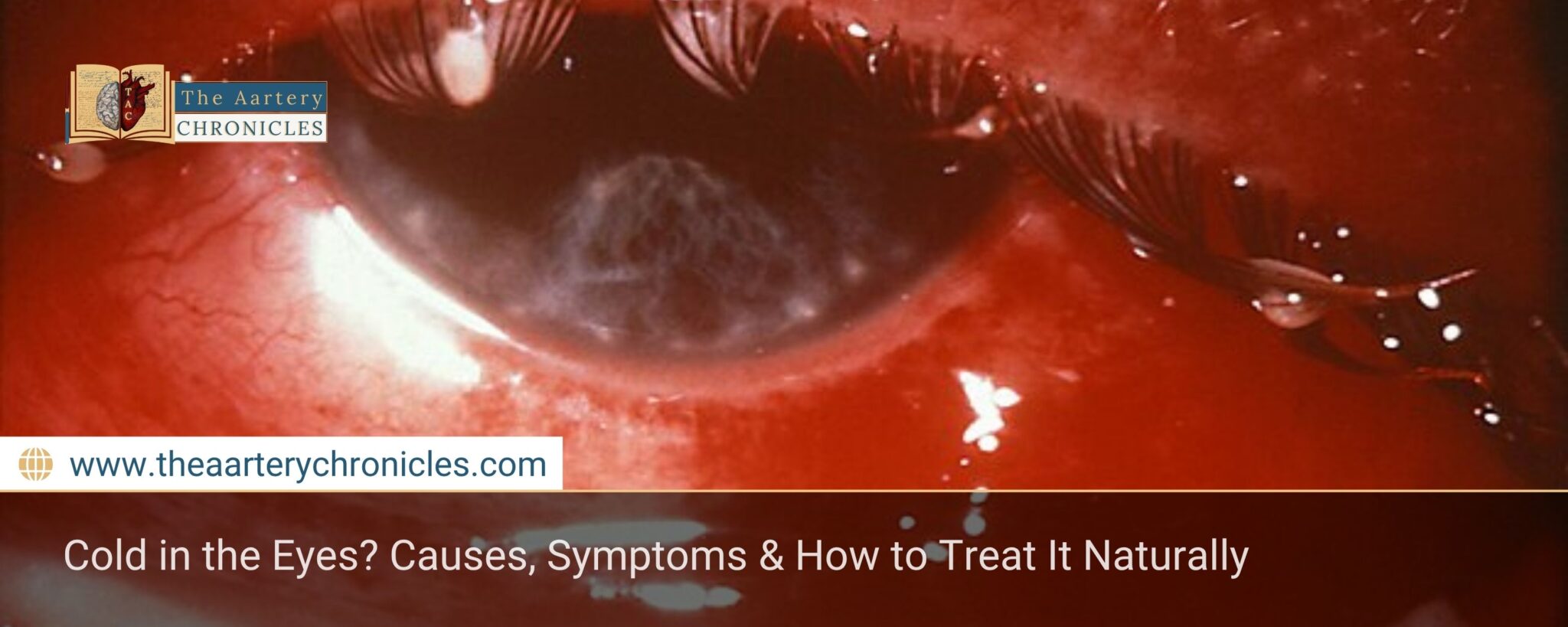 Cold in the Eyes? Causes, Symptoms & How to Treat It Naturally