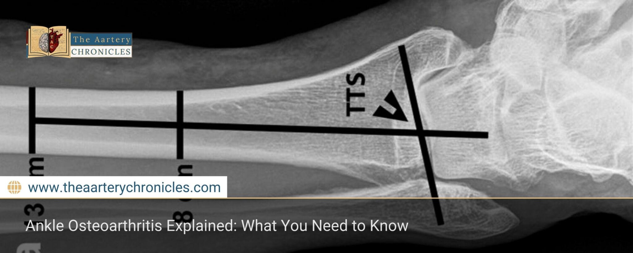 Ankle Osteoarthritis Explained: What You Need to Know