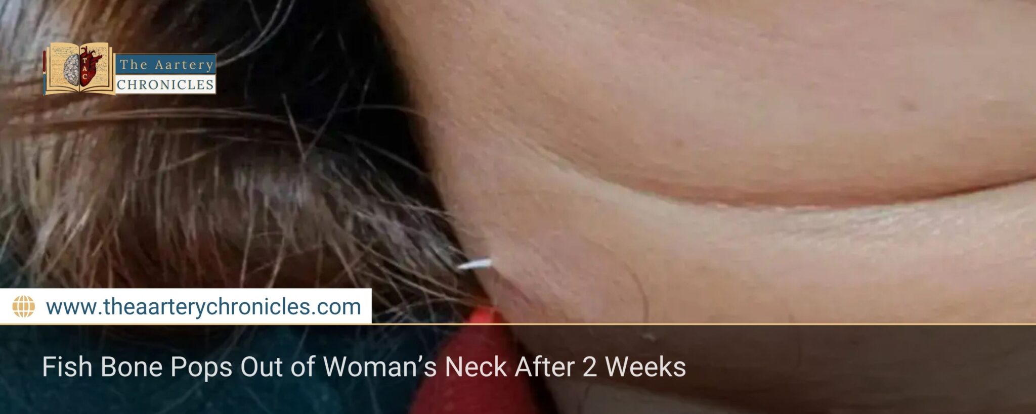Fish Bone Pops Out of Woman’s Neck After 2 Weeks