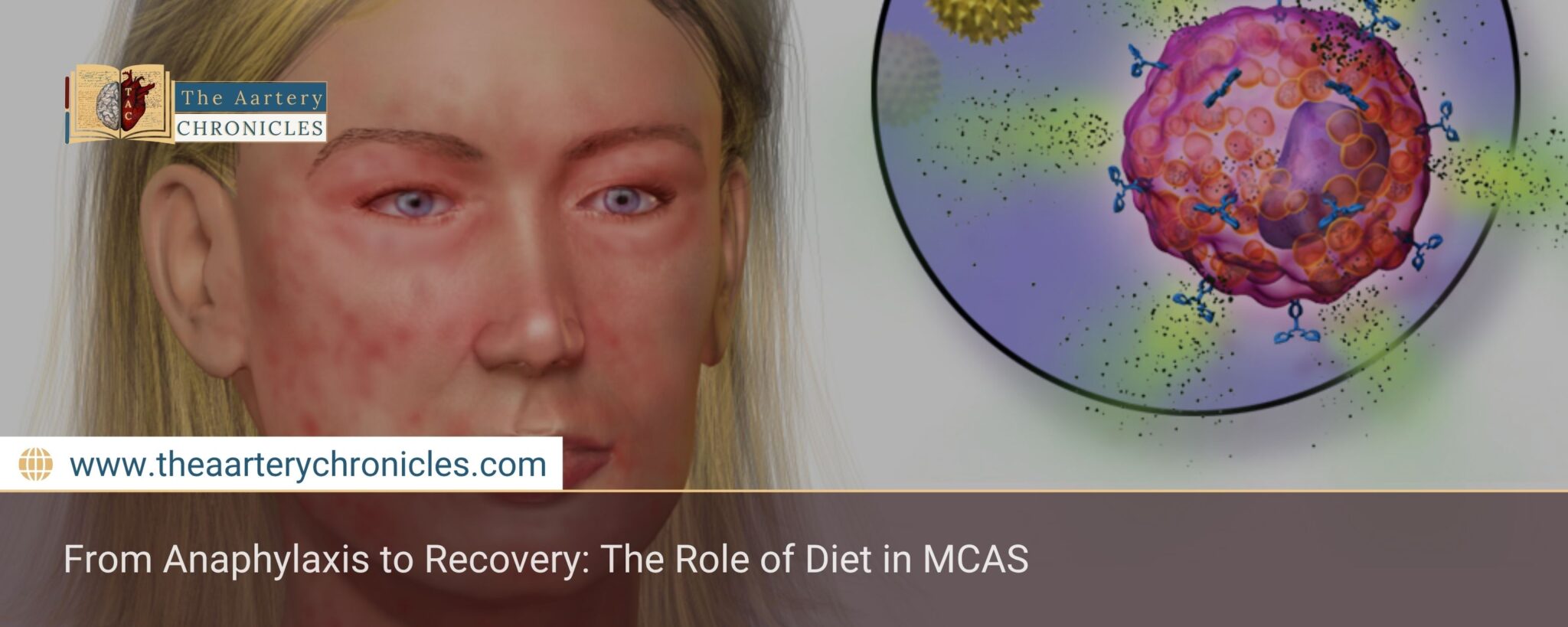 From Anaphylaxis to Recovery: The Role of Diet in MCAS